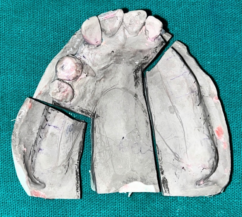 Revolutionizing Rehabilitation: Prosthodontic Management of Distal Extension Using Cobalt ...